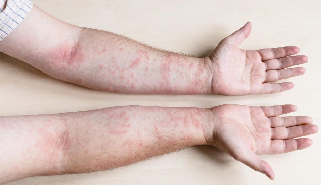Contact Dermatitis Treatment In Singapore - Dermatology Collective