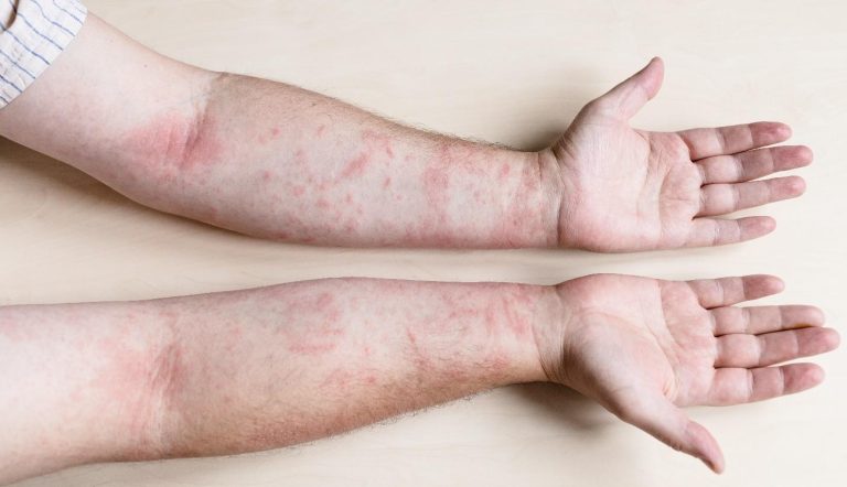 Contact Dermatitis Treatment In Singapore - Dermatology Collective
